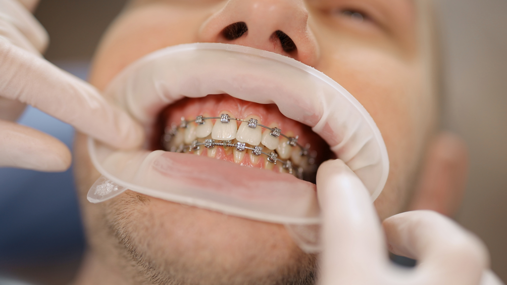 Fixed Orthodontic Treatments (Wire Treatment) - İkon Diş - Ağız ve Diş ...